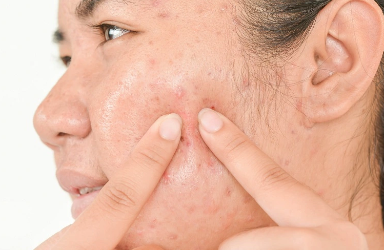 Cara Mengatasi Jerawat dalam Semalam | Uspace.id